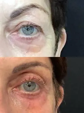 Non Surgical Brow Lift | Anna Medical Aesthetics