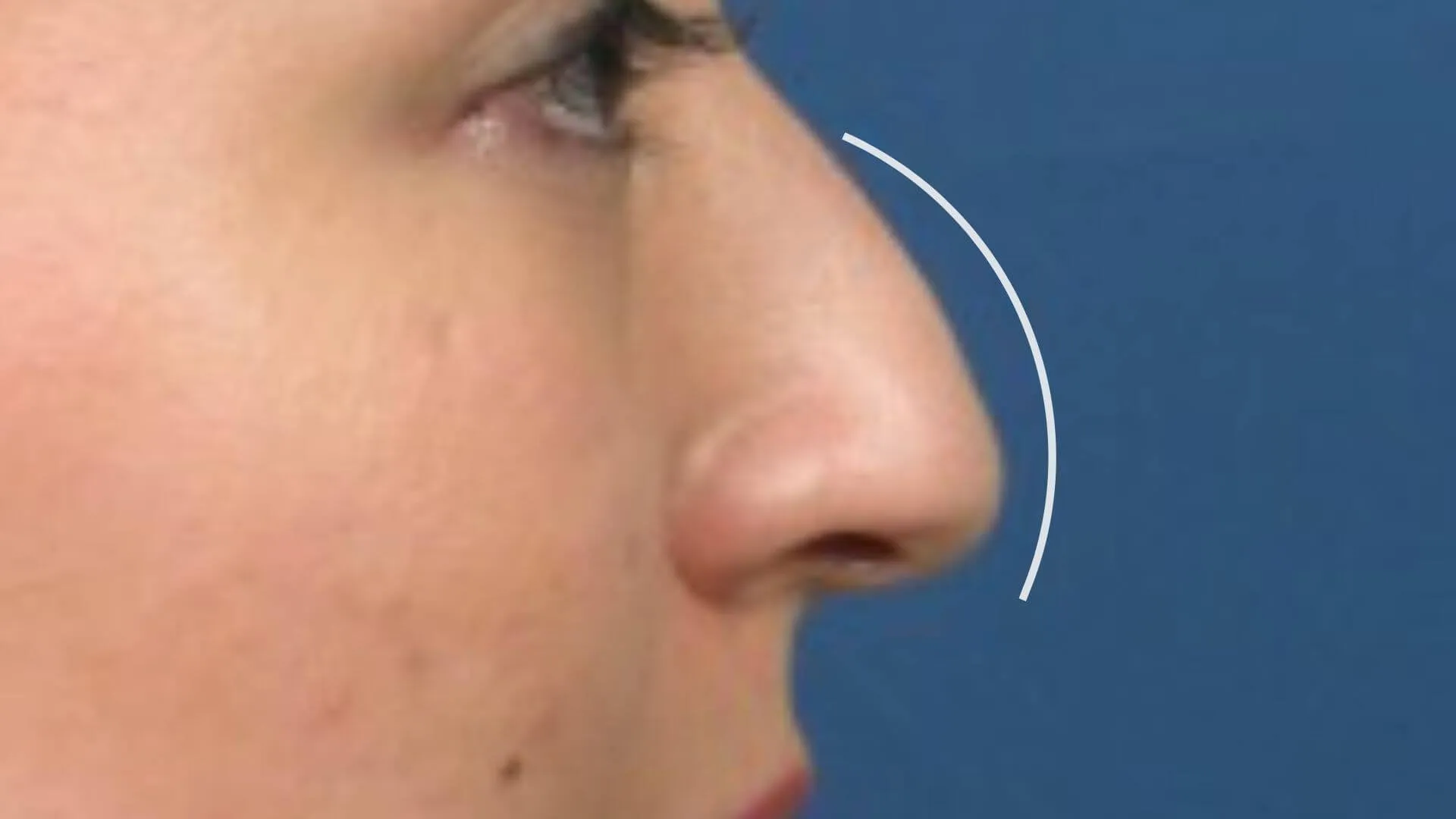 Drooping Nose Tip | Anna Aesthetics Beauty Medical Clinic