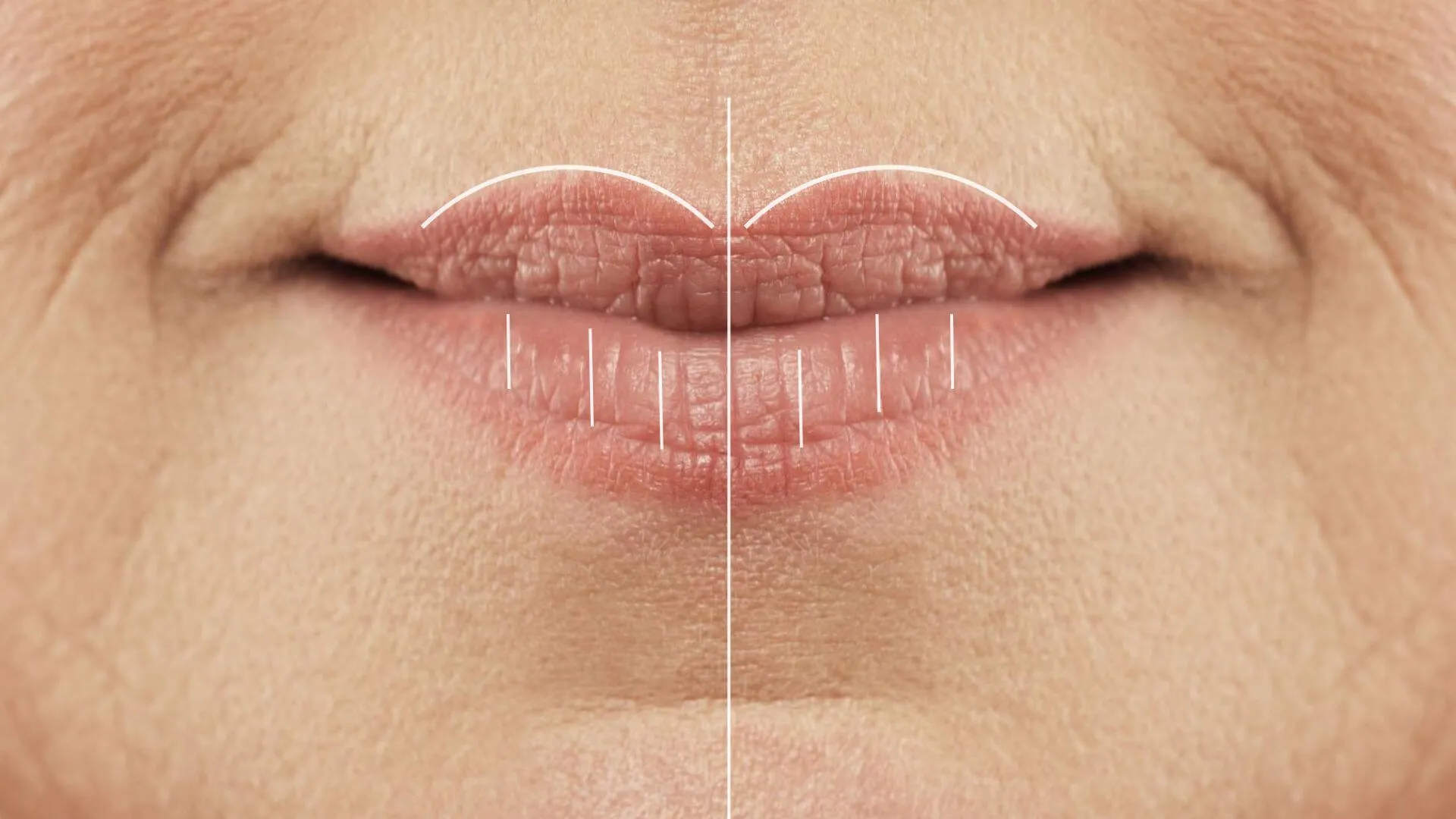 Lip Lines | Swindon Aesthetics Beauty Clinic