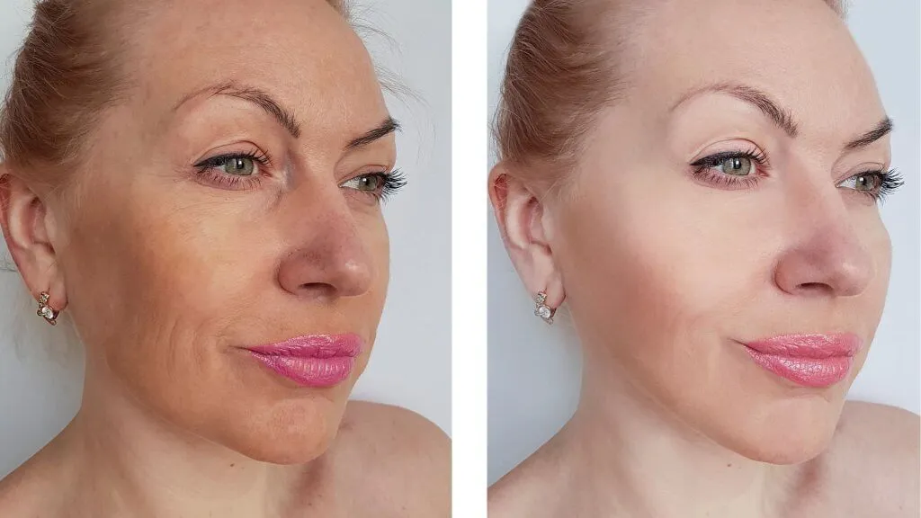 Risks of Botox: An In-Depth Look