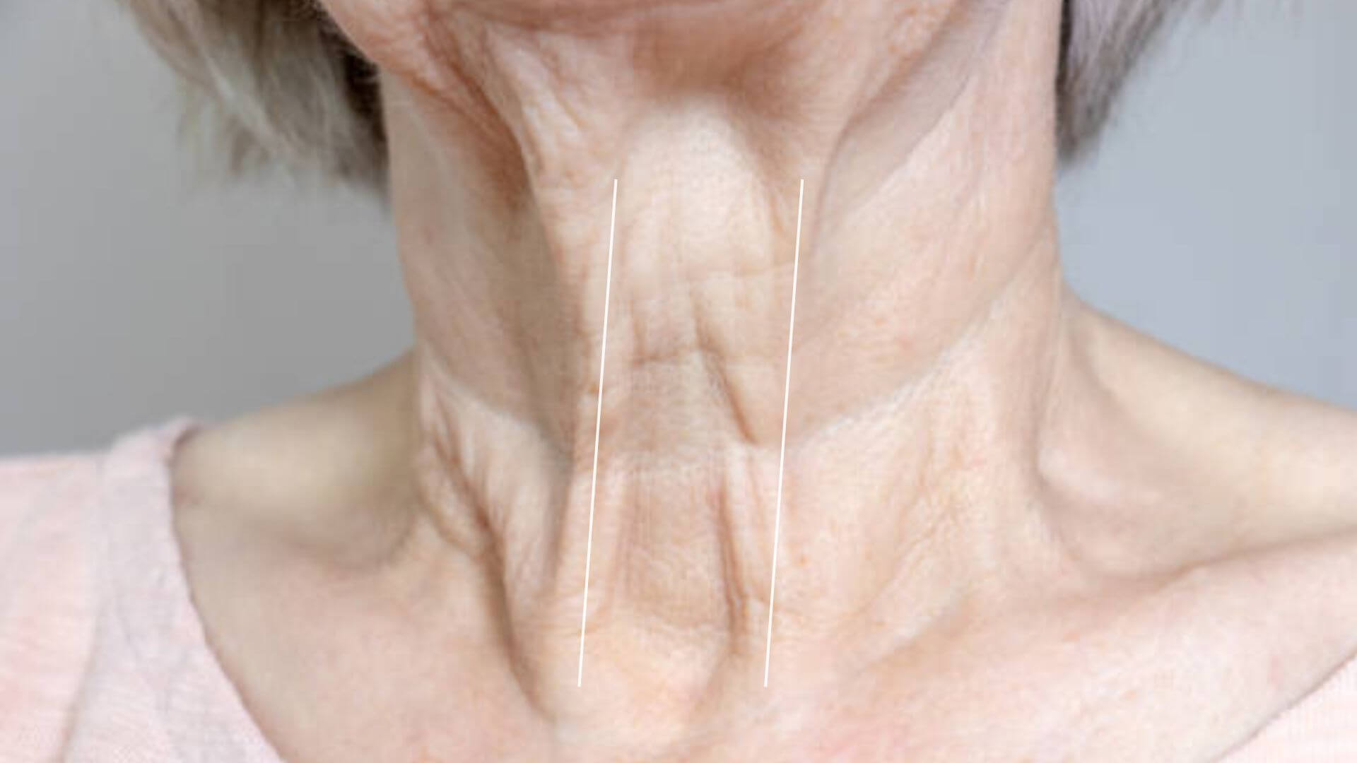 Vertical Neck Lines | Top Beauty Clinic Near Swindon